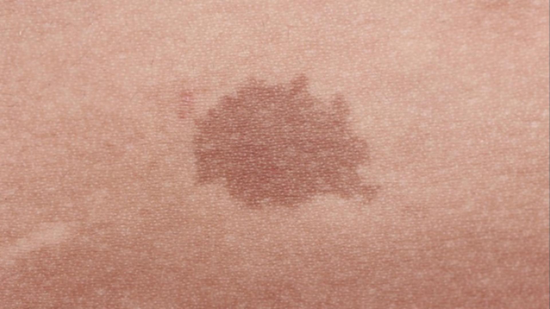 Află semnificația semnelor din naștere și ce influență au asupra vieții ...